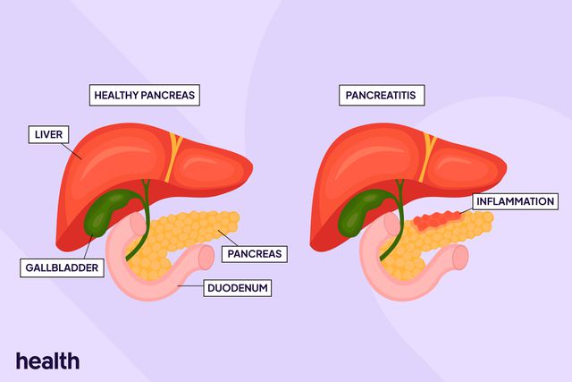 How Is Pancreatitis Treated?