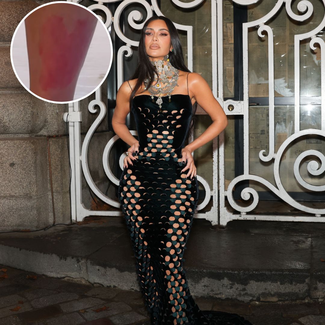 Embracing Her Imperfections! Kim Kardashian Reveals Painful Psoriasis ...