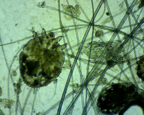 Scabies outbreak in UK universities – what you need to know