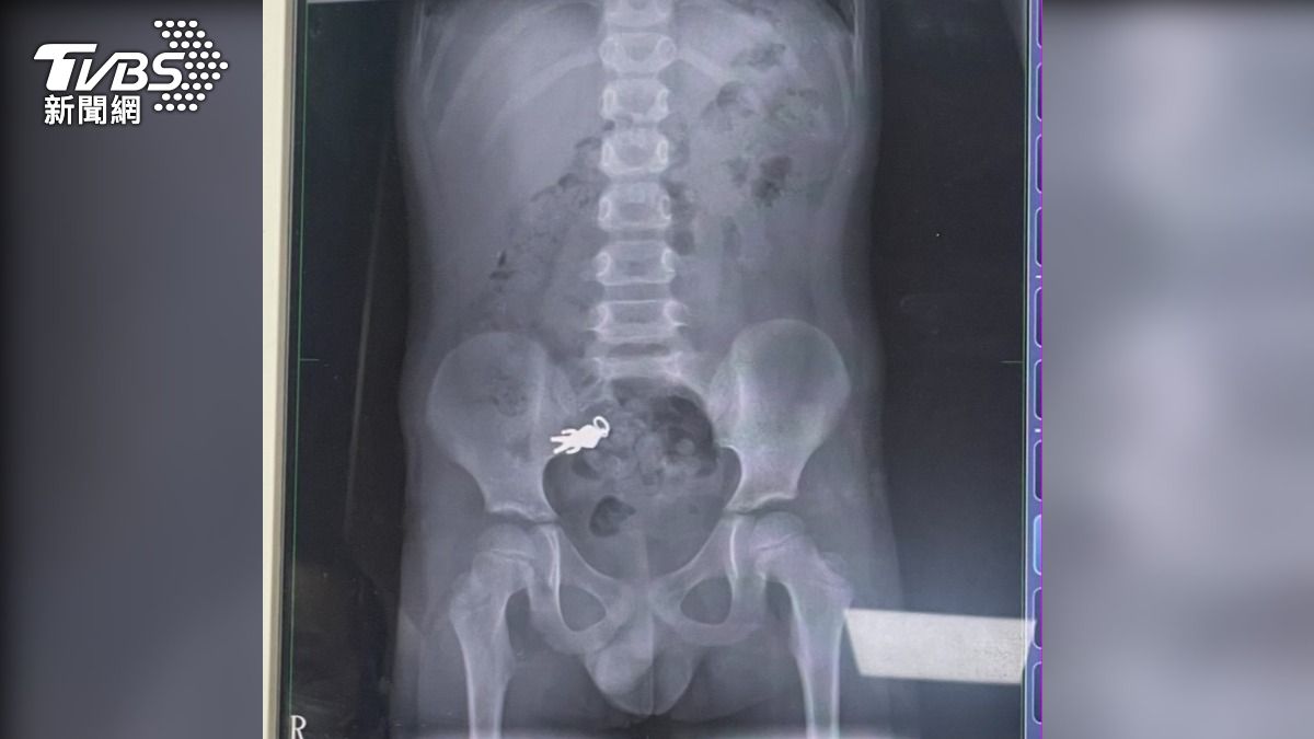 想變身？8歲童吃餅乾配電視 誤吞2cm「超人力霸王」